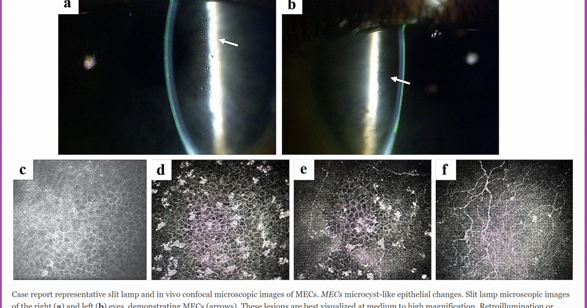 Corneal Findings in Novel Cancer Drug Class | Department of ...